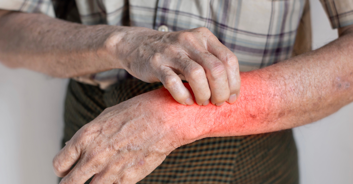 Natural Ayurvedic Treatment for Fungal Infection and skin allergy