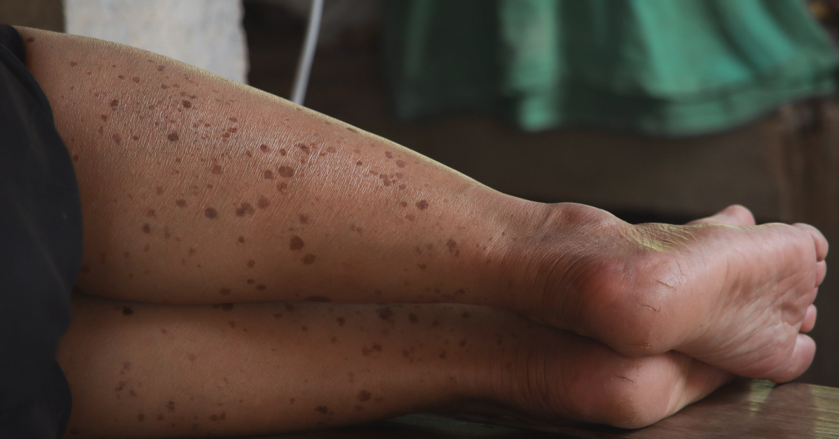 How to Remove Black Spots on Legs Causes, Symptoms and Ayurvedic Treatments