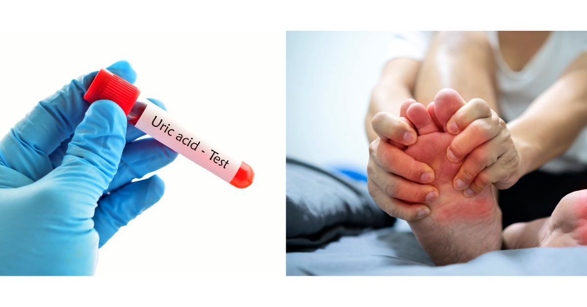 High Uric Acid Causes, Symptoms & Ayurvedic Remedies