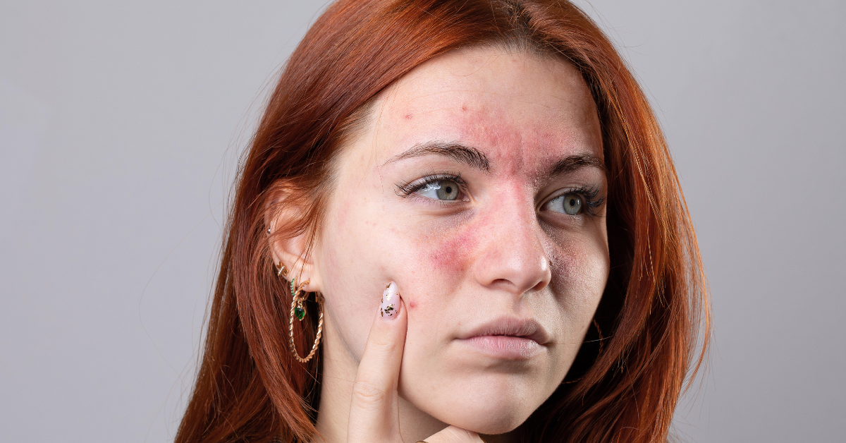 Red Patches on Skin: Causes, Symptoms & Home Remedies for Treatment